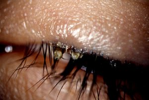 Göz Kapağı İltihabı (Blefarit) Nedir ve Tedavisi - AkıllıMercek Göz ...